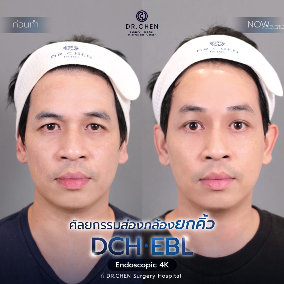 ศัลยกรรมยกคิ้ว DCH EBL Endoscopic 4K - DCH Dr.CHEN Surgery Hospital ...