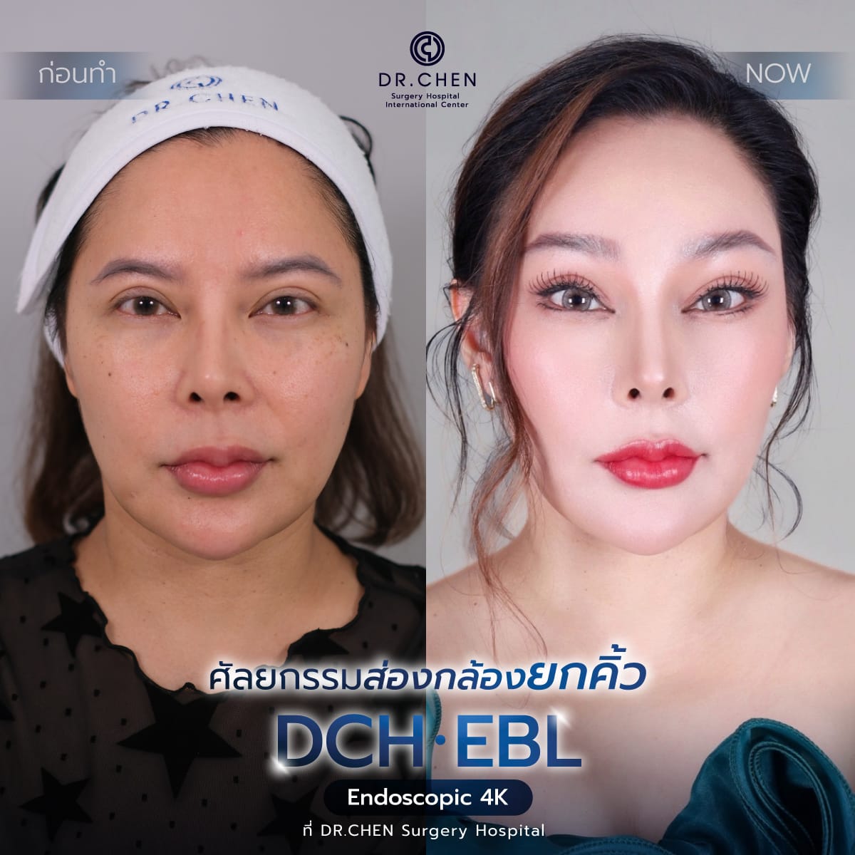 ศัลยกรรมยกคิ้ว DCH EBL Endoscopic 4K - DCH Dr.CHEN Surgery Hospital ...