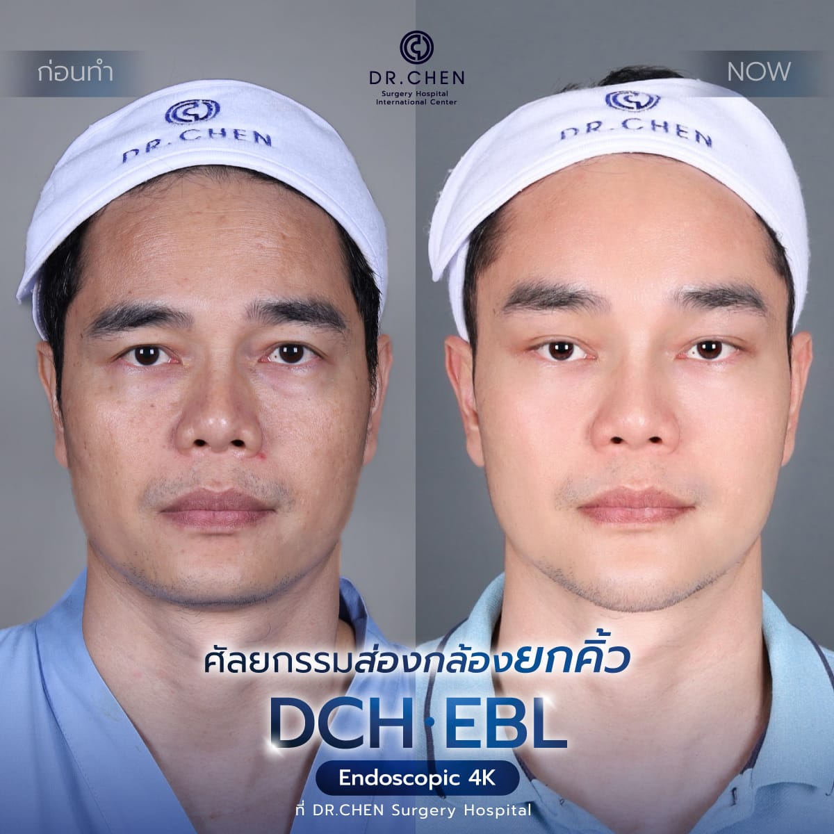 ศัลยกรรมยกคิ้ว DCH EBL Endoscopic 4K - DCH Dr.CHEN Surgery Hospital ...